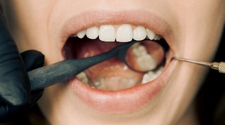 Why Do People Go For Turkey Teeth? - Healthy Celeb